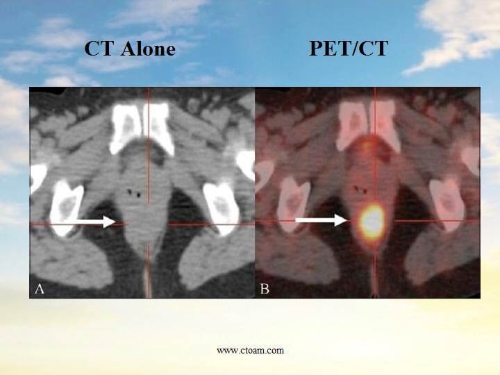 CT Vs Pet Scan CT Vs Pet Scan